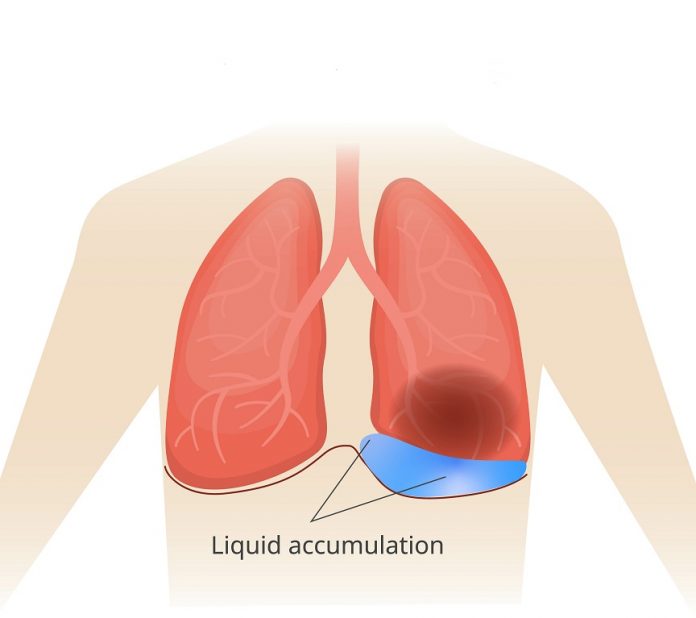 Insuffisance Cardiaque Et Épanchement Pleural – YNAK